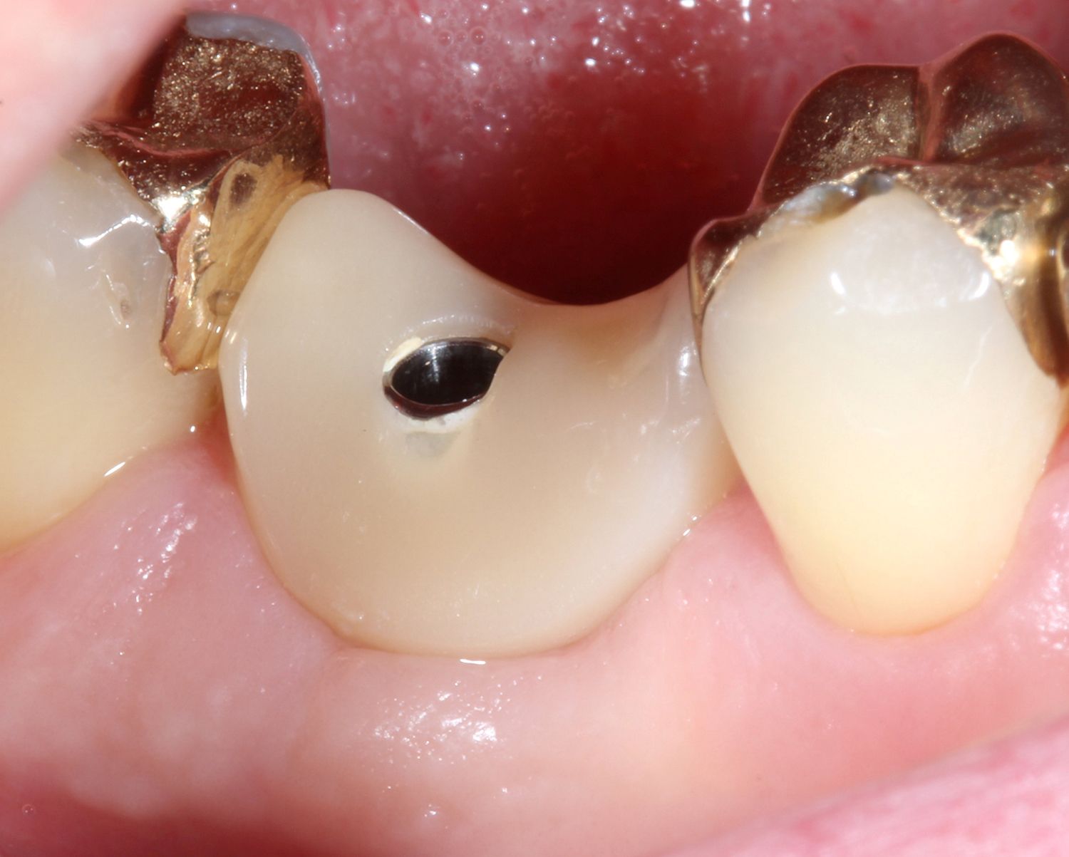 Digitale und analoge Abformungen für eine starke Implantatprothetik
