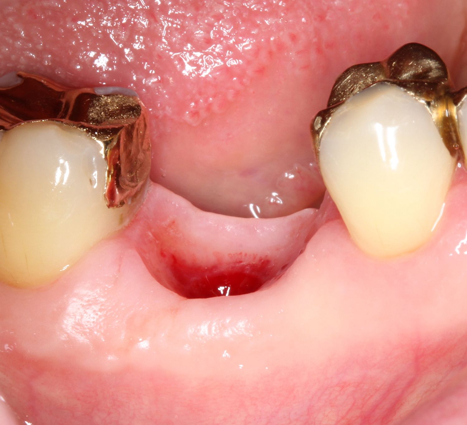 Digitale und analoge Abformungen für eine starke Implantatprothetik