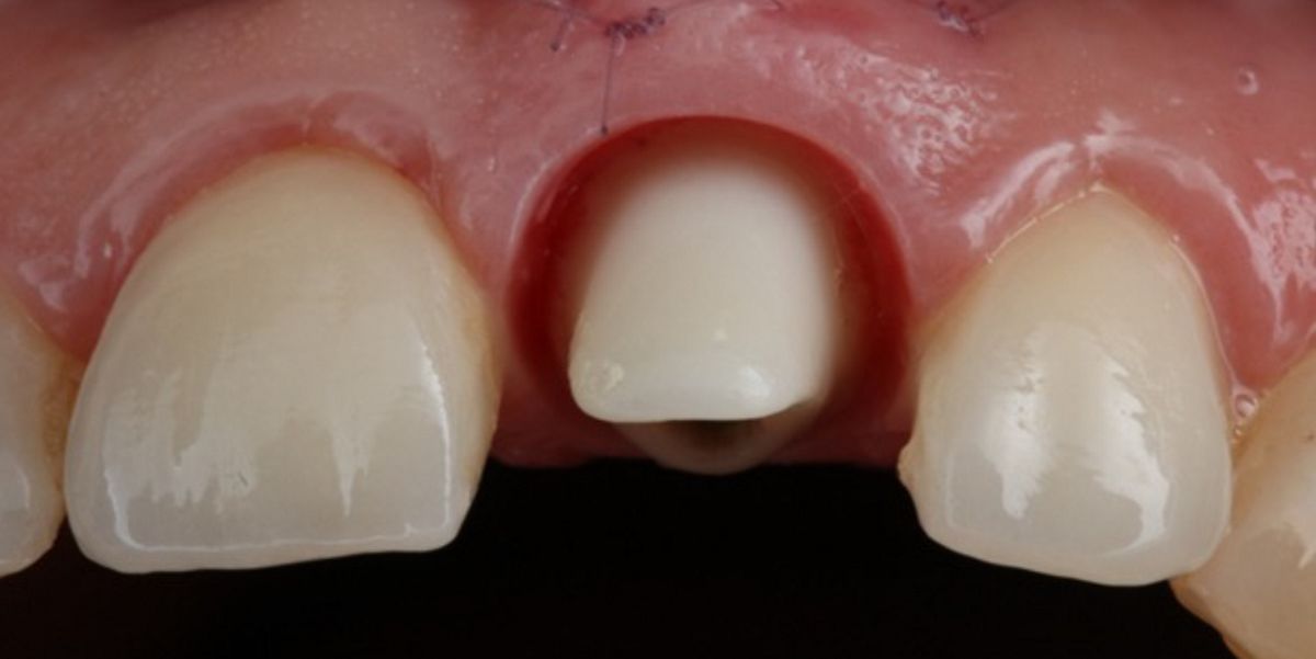 coDiagnostiX AI Virtual Tooth Extraction for immediate replacement of a ...