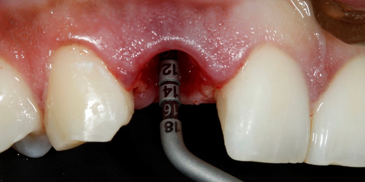 Straumann® BLX immediate implant placement and provisional restoration ...