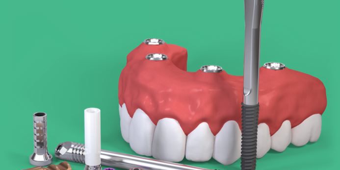 Zygomatic Arkadium Zygomatic Implants