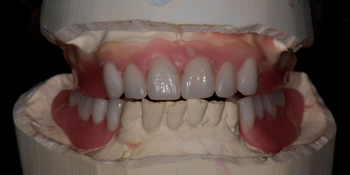 An Optimal Cost-Effective Prosthetic Solution with LOCATOR FIXED®