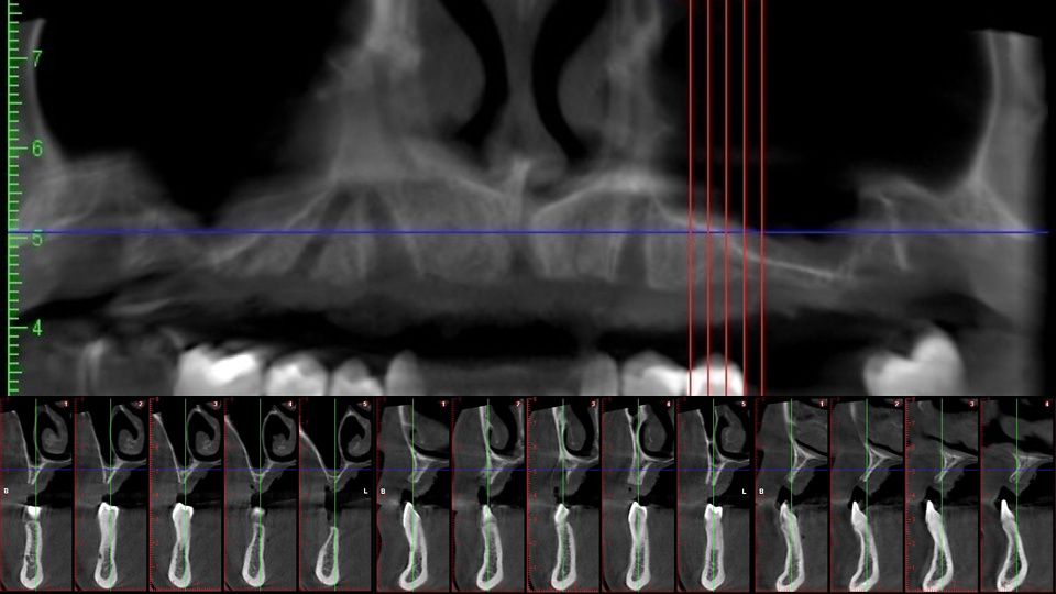 Full arch reconstruction of the edentulous maxilla: from bone ...