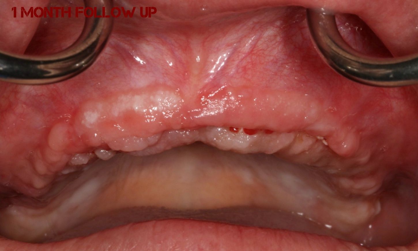 maxillary exostosis cpt code