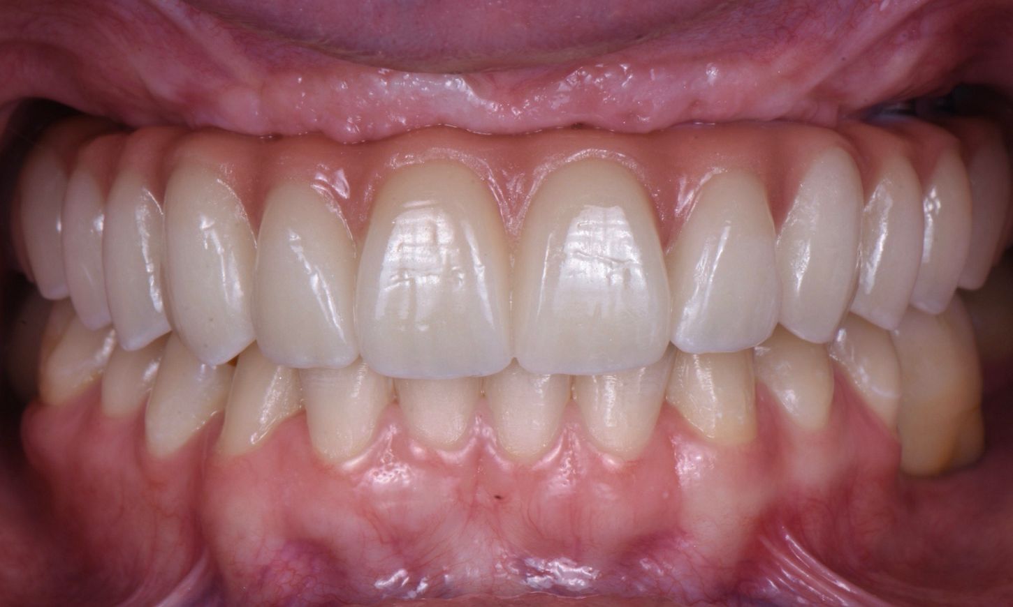 Full arch reconstruction of the edentulous maxilla: from bone ...