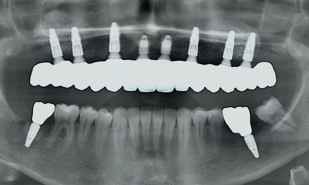 Full arch reconstruction of the edentulous maxilla: from bone ...