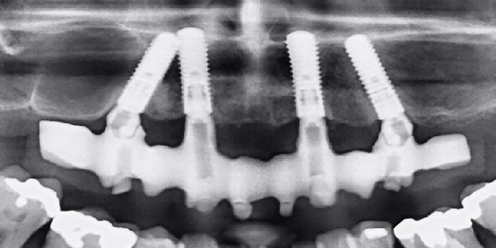 Full-arch maxilla restoration with immediate implant loading: a 10-year ...