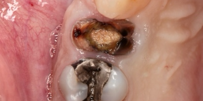 Straumann® XenoFlex: Preserve the alveolar ridge, avoid sinus lifts ...