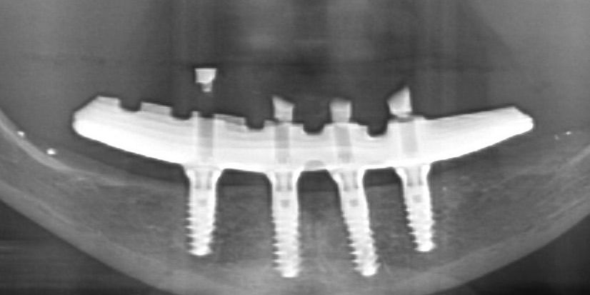 Full-arch rehabilitation with Straumann® TLX implants in a severely ...
