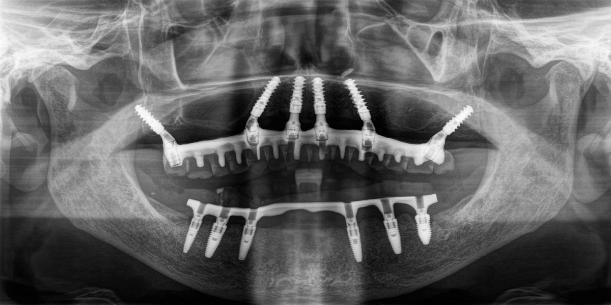 Total rehabilitation of a fully edentulous maxilla with immediate ...