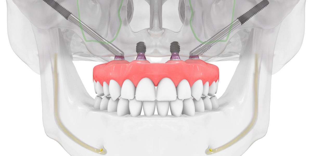Full arch reconstruction of the edentulous maxilla: from bone ...