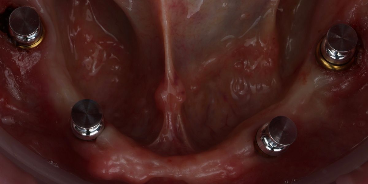 Combining clinical simplicity and patient comfort with Straumann ...