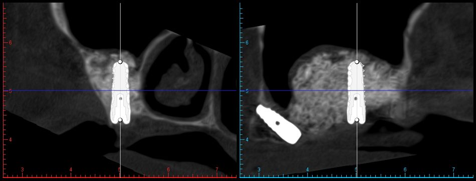 Full-arch rehabilitation using Straumann iEXCEL™ implants (BLX, BLC ...