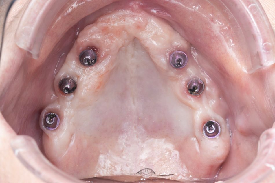 Full-arch rehabilitation using Straumann iEXCEL™ implants (BLX, BLC ...