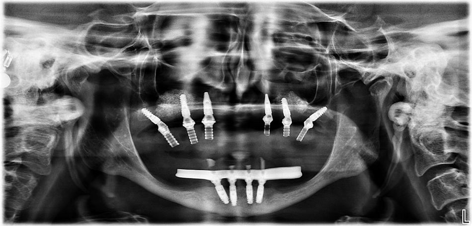 Full-arch rehabilitation using Straumann iEXCEL™ implants (BLX, BLC ...