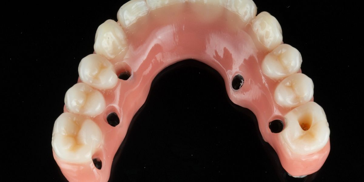 Full-arch rehabilitation using Straumann iEXCEL™ implants (BLX, BLC ...