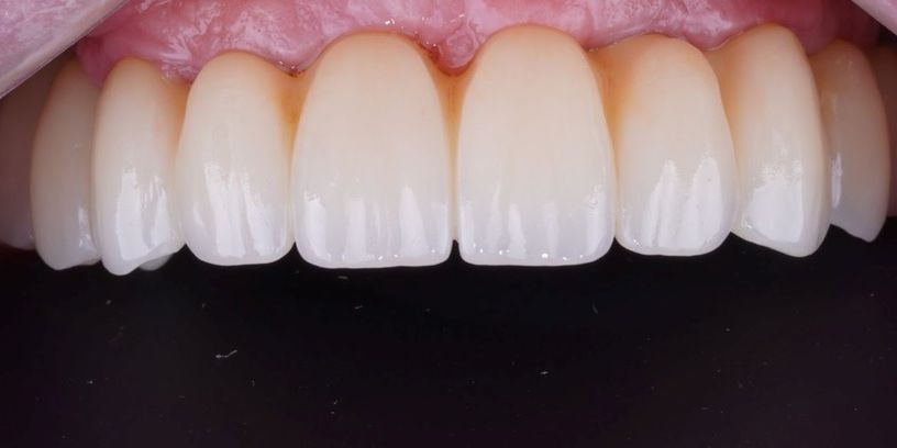 Full-arch rehabilitation using Straumann® Roxolid® ⌀3.3 mm implants ...