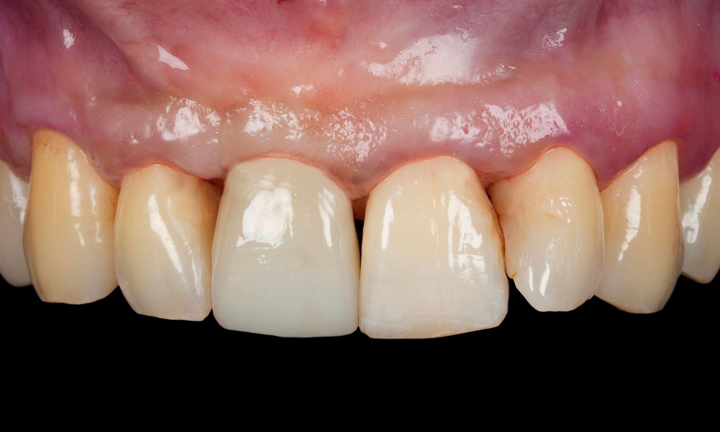 Periimplantitis-Behandlung mit GalvoSurge® und GBR