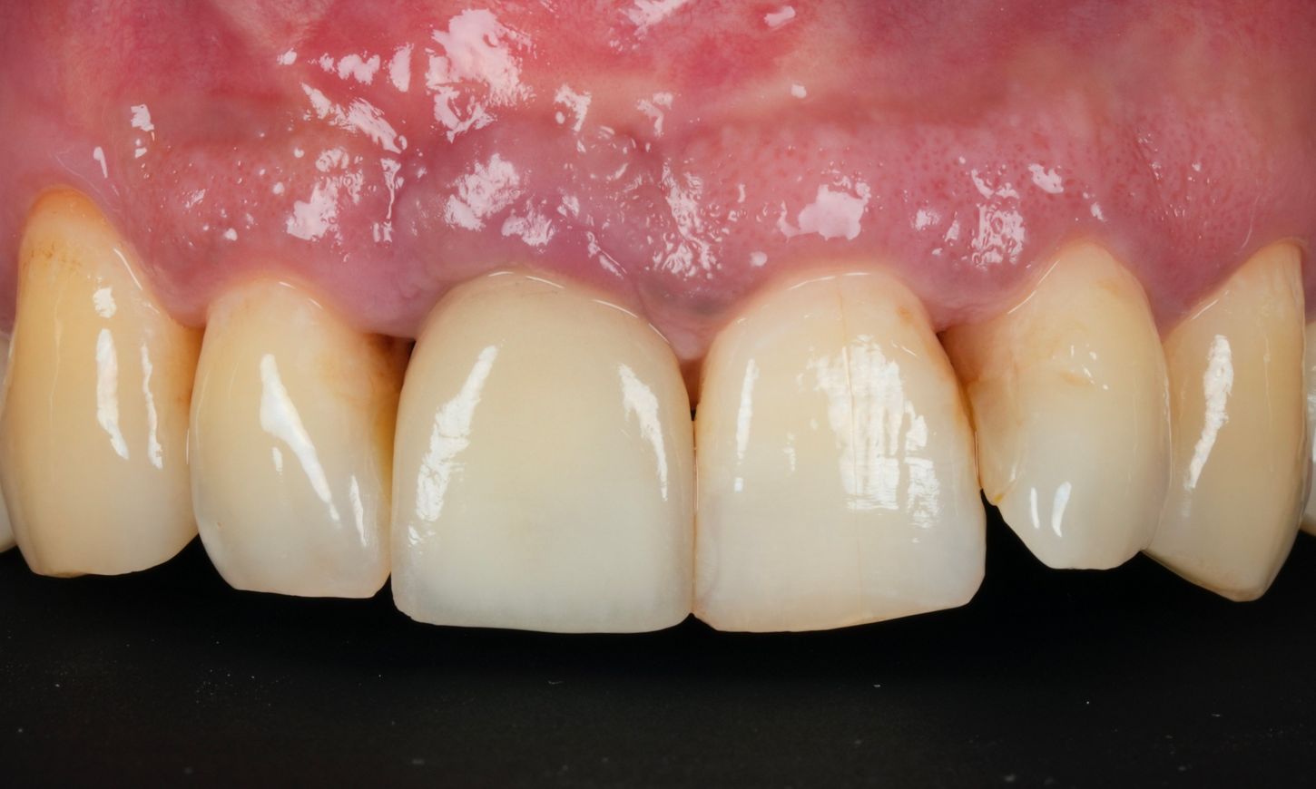 Periimplantitis-Behandlung mit GalvoSurge® und GBR