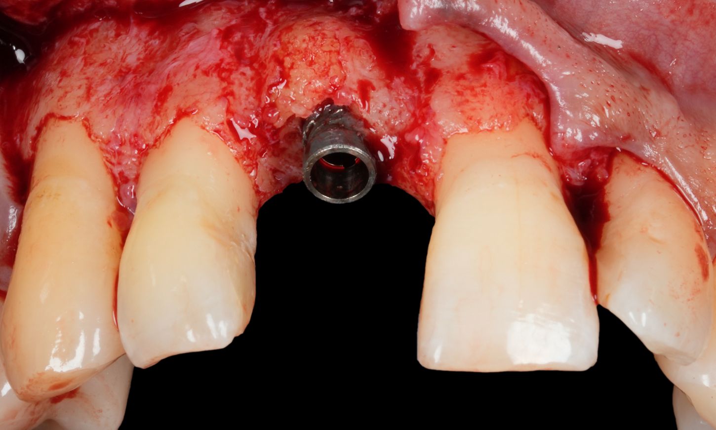 Periimplantitis-Behandlung mit GalvoSurge® und GBR