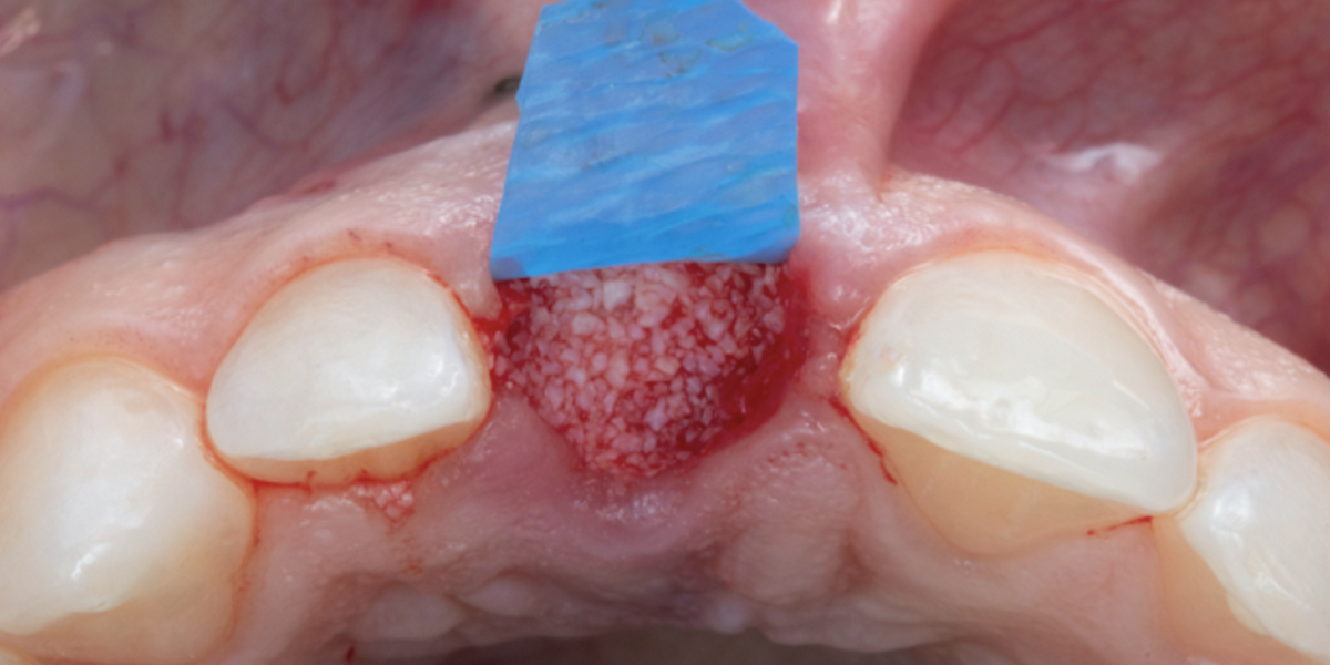 Minimally invasive alveolar ridge reconstruction using permamem® and ...