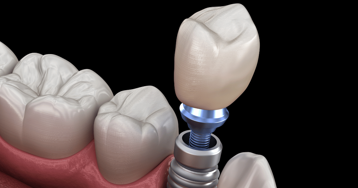 The Role Of Healing Abutments For Dental Implants | TeethToday